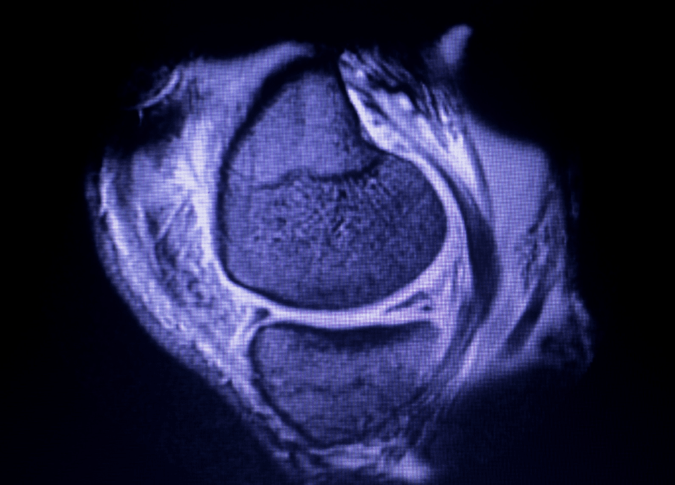 Knee Function in Degenerative Meniscal Tears | Research Review