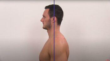 Observation & Posture Analysis | Basic Physiotherapy Assessment