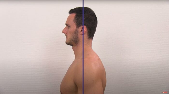 Observation & Posture Analysis | Basic Physiotherapy Assessment