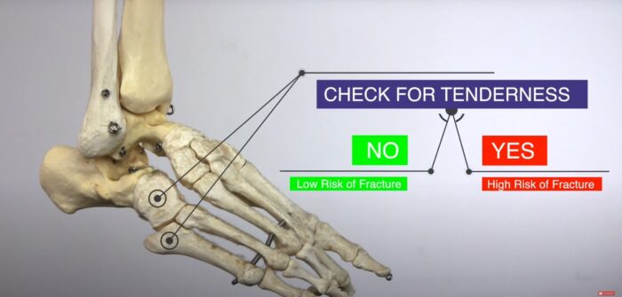 Midfoot Zone Algorithm | Ankle Fracture Assessment in Children