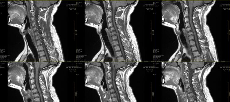 Radicular Pain Drawings and MRI findings | Research Review