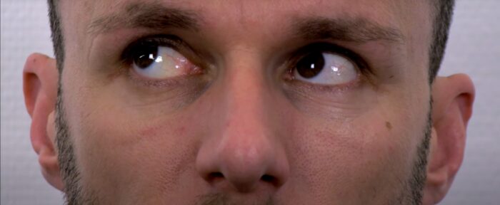 Abducens Nerve | Cranial Nerve VI / CN VI Assessment