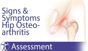 Hip Osteoarthritis Diagnosis | Signs & Symptoms of Hip OA