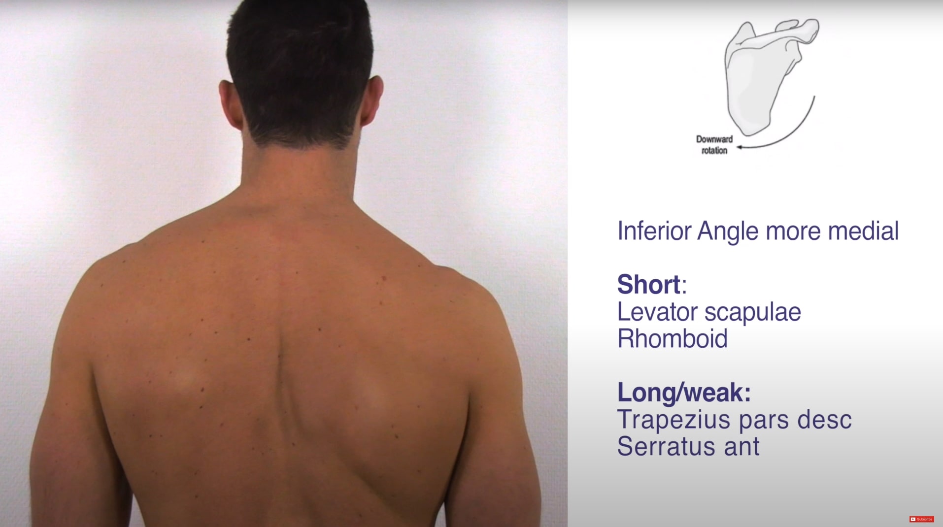 Upwardly Rotated Scapula Upwardly Rotated Scapula