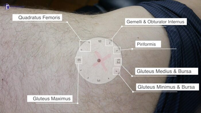 Greater Trochanter Palpation | Gluteal Tendinopathy (GTPS)