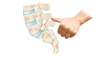 Low Midline Sill Sign | Radiographic Lumbar Instability Assessment
