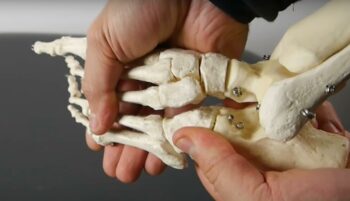 Cuboid Syndrome after lateral ankle sprain | Diagnosis & Treatment