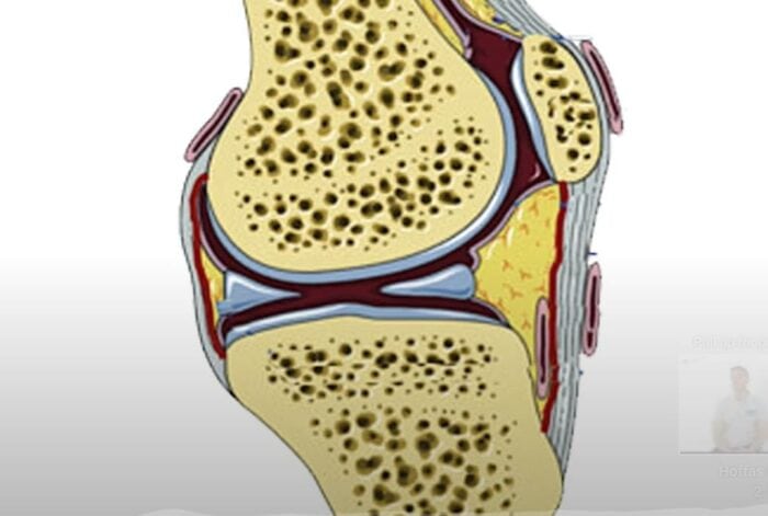 Infrapatellar Fat Pad Syndrome | Diagnosis & Treatment