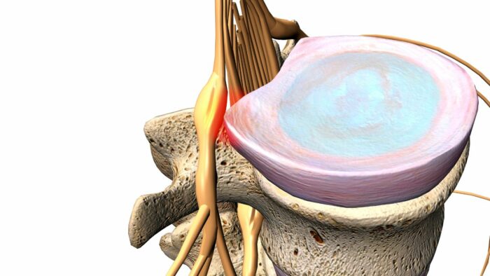 Lumbar Radicular Syndrome | Diagnosis & Treatment for Physios