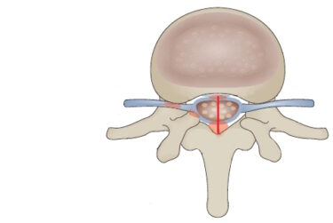 Lumbar Spinal Stenosis | Diagnose & Behandeling voor Fysio's