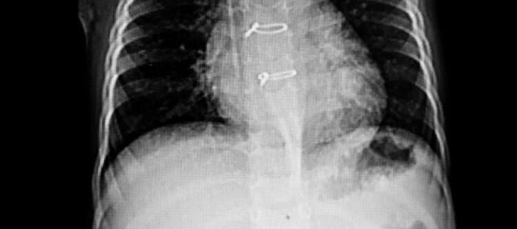 Trunk Stabilizing Exercises Post-Sternotomy - Physiotutors