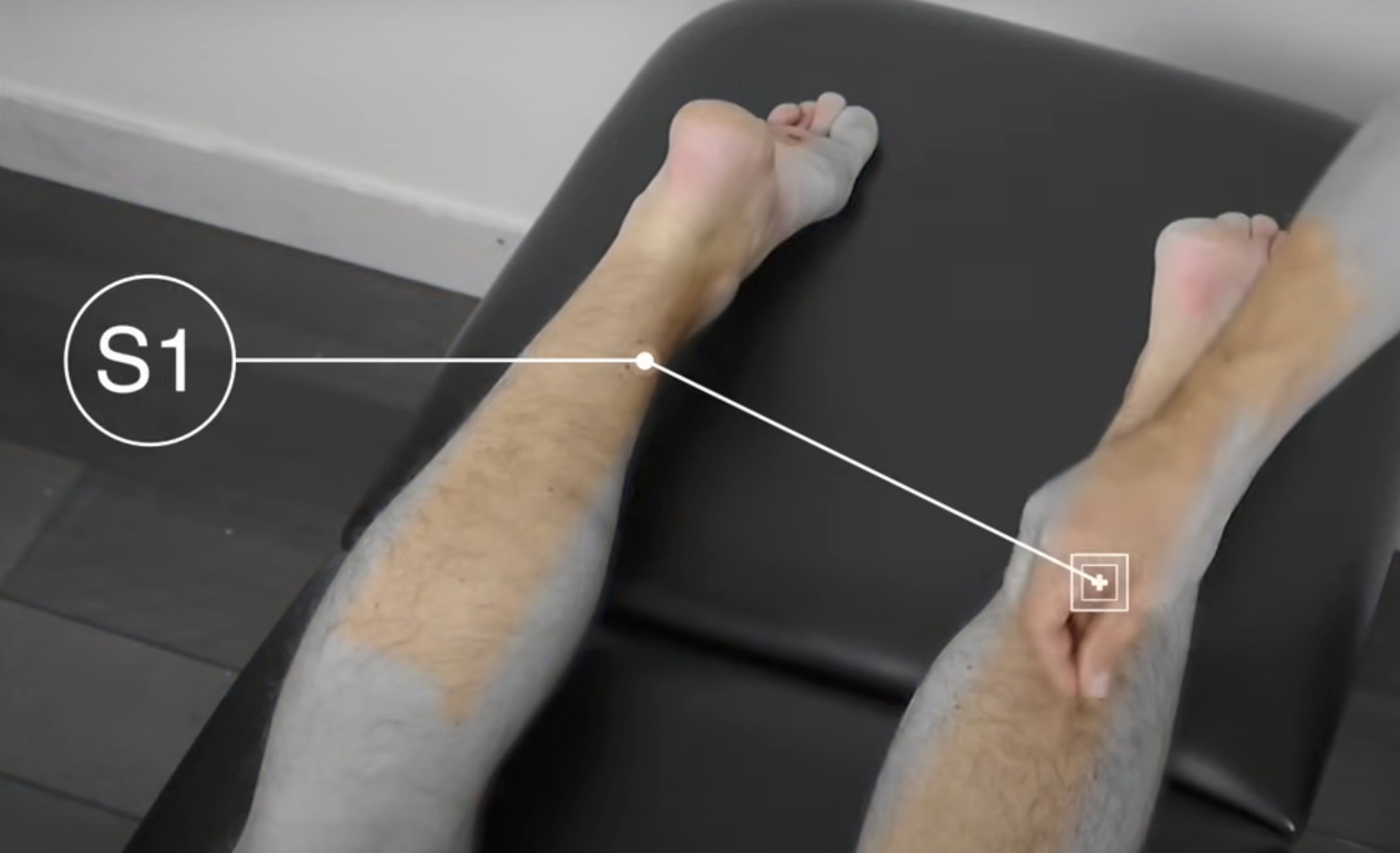 Dermatome testing S1 - Physiotutors