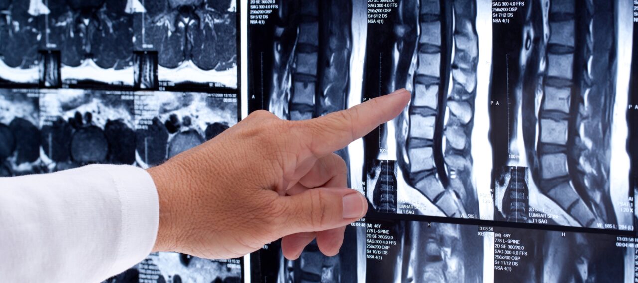 Can Mobilization Techniques Cause Herniation Regression? - Physiotutors